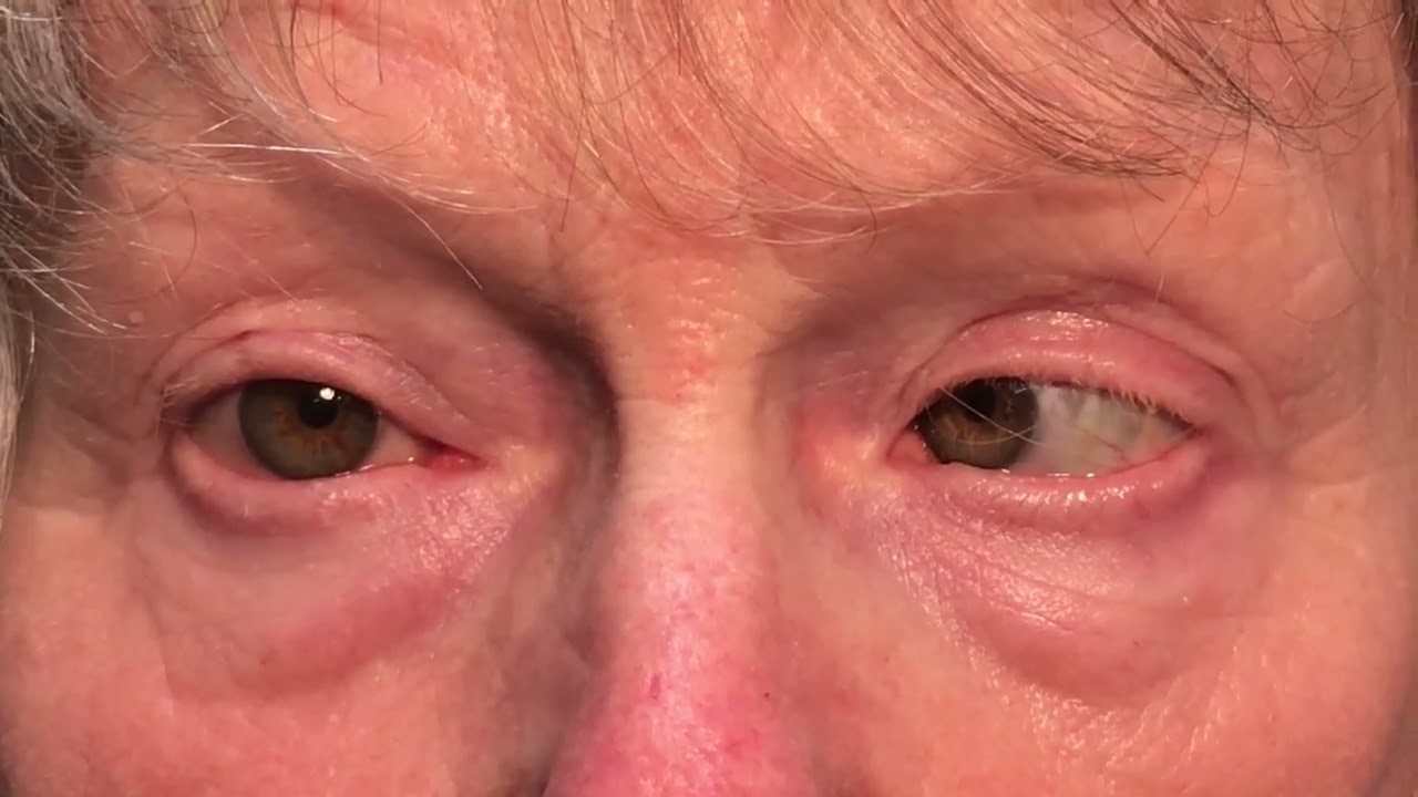6th Nerve Palsy [ARCHIVE]
