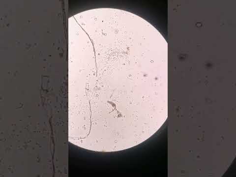 Urinary Tract Infection under the microscope | Pyuria | #lab #mls #cls #microscope #medtechstudent