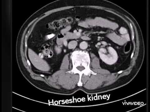 Horseshoe kidney - CT