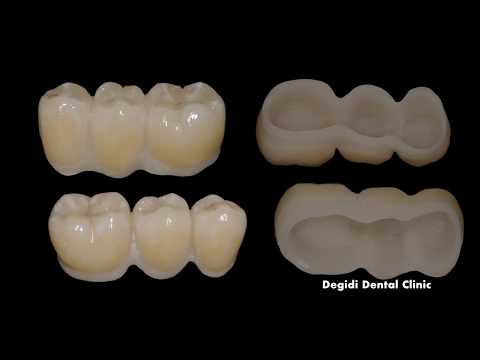 Weld-on-4 case with 3 concepts: WeldOne, Conometric and Cerec.
