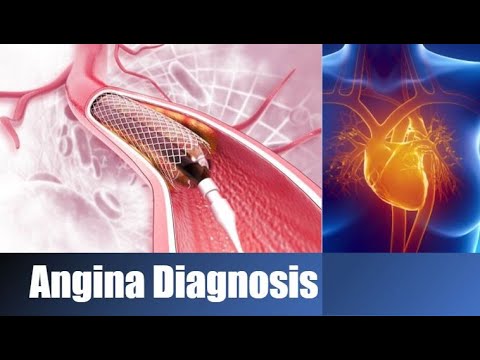 How do doctors diagnose angina?