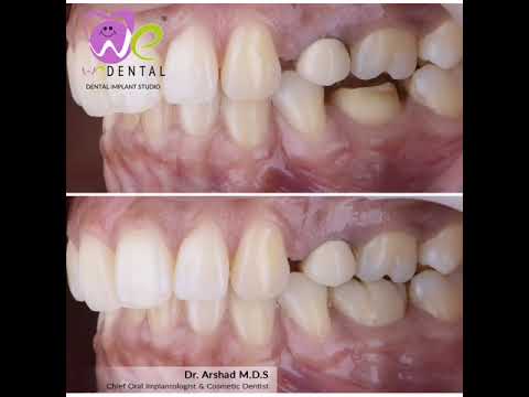 Zirconia| Crown| We Dental| Best Dental| Dr Arshad| Molar esthetics| All ceramic| Backtooth esthetic
