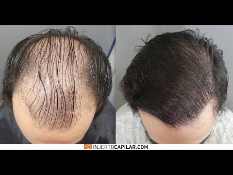7202 FUE Grafts. 2 step strategy. NW V. Shaved before 2nd procedure. Injertocapilar.com.1949/2017