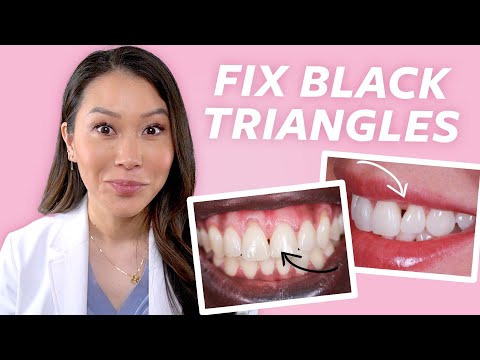FIX Gaps in Teeth - How to Close Black Triangles
