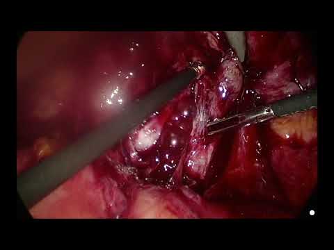 Principles of surgery for tube-ovarian abscess. Application in a complex case with severe sepsis.