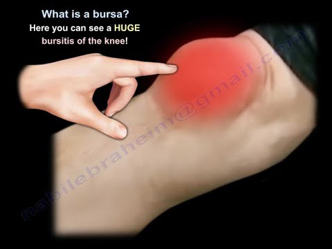 What Is BURSITIS ?- Everything You Need To Know - Dr. Nabil Ebraheim
