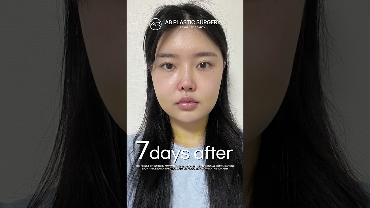 [Plastic surgery in Korea] Cheekbone + Mandible Jaw Review #abplasticsurgery