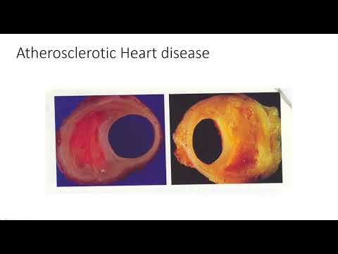 PVD and CAD 3: Coronary Artery Disease