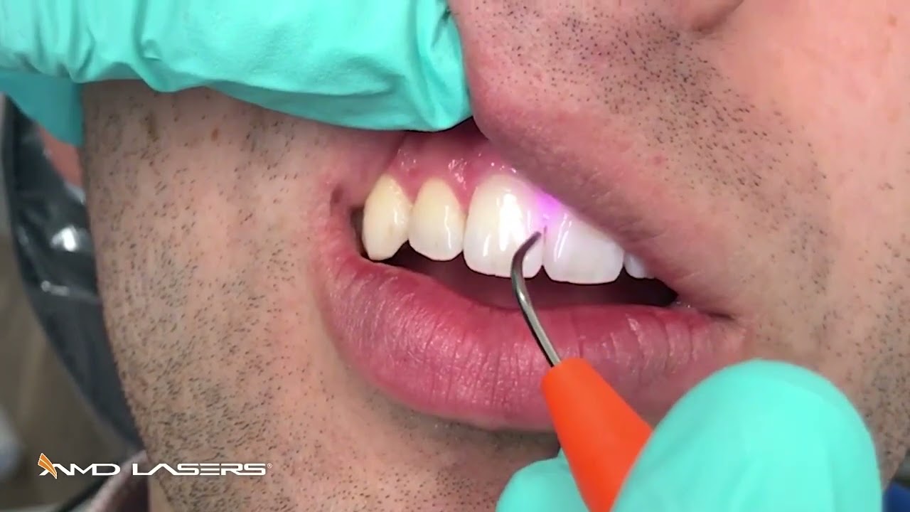 Sulcular Debridement with a Picasso Laser