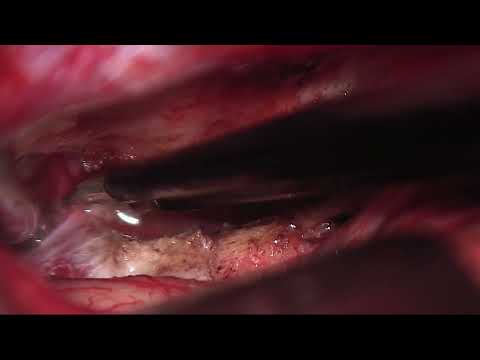 #Clinoidal_meningioma, #Supraorbital keyhole craniotomy under #EXOSCOPE