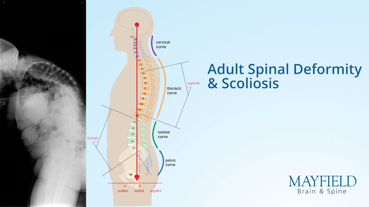 Adult Spinal Deformity and Scoliosis