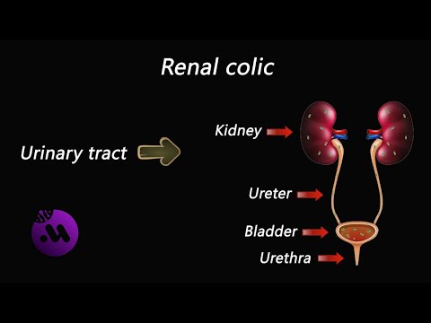 Renal colic - Symptoms and treatment