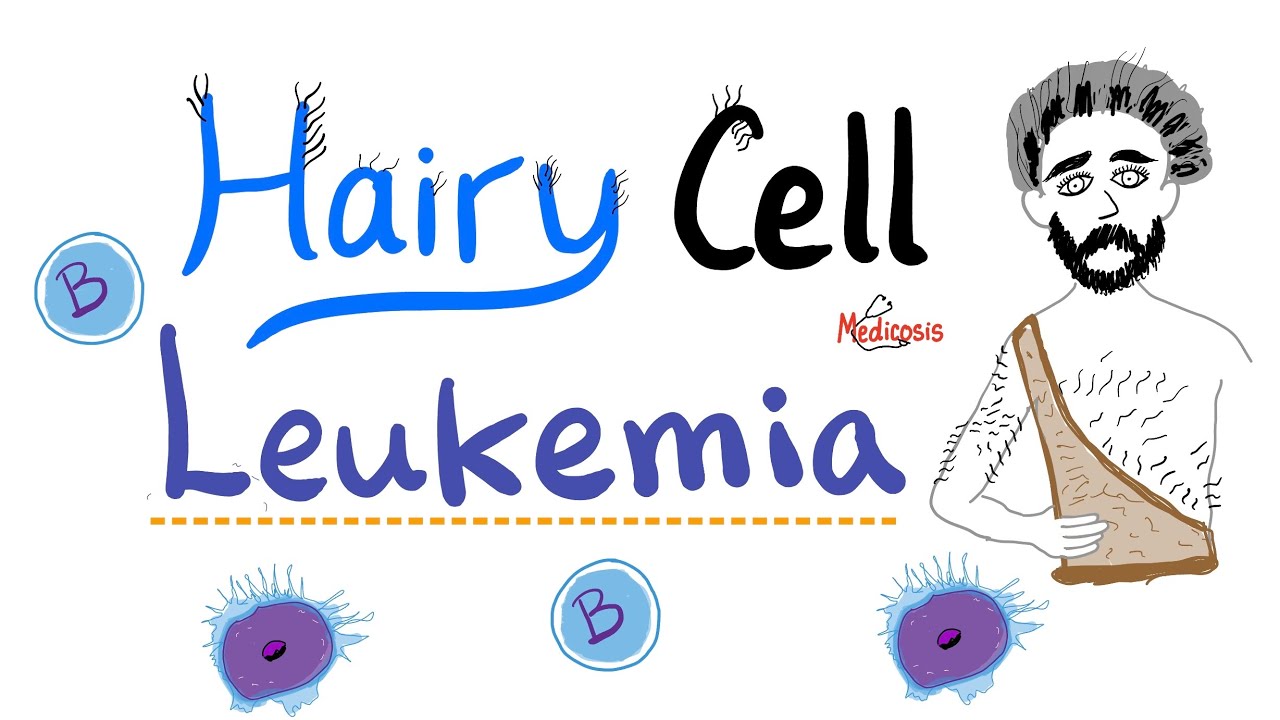 Hairy Cell Leukemia (HCL) - B-cell Neoplasm - TRAP +  - Cladribine Therapy - Hematology and Oncology