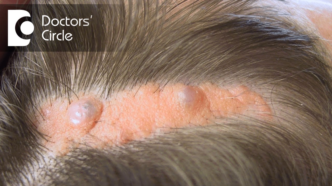 What causes Sebaceous Cyst on the scalp? - Dr. Nischal K