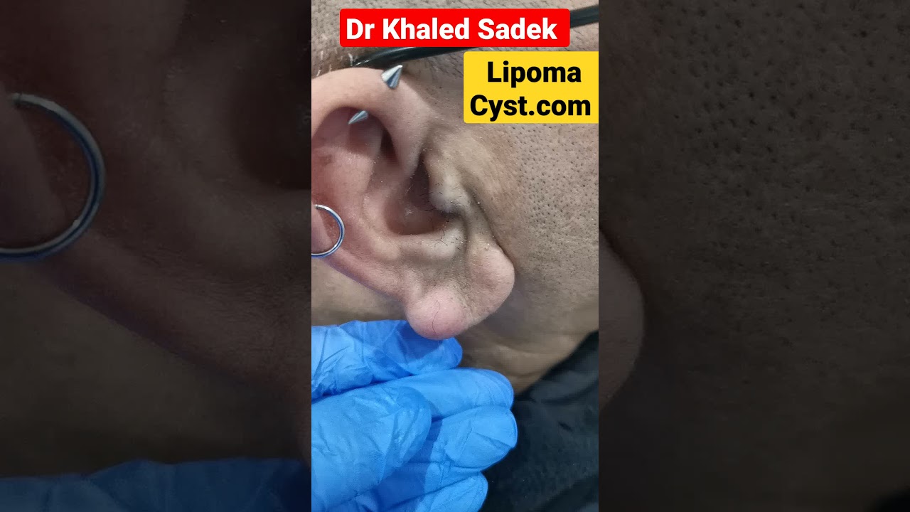 ear cyst! #shorts #cystremoval #skincare #pimplepopper Dr khaled sadek Lipomacyst.com
