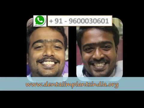 New teeth New smile in chennai