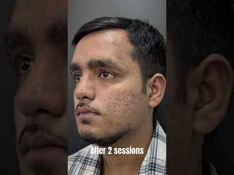 Best acne scar treatment in india #acnescars #acnescarsremoval #acnescarstreatment