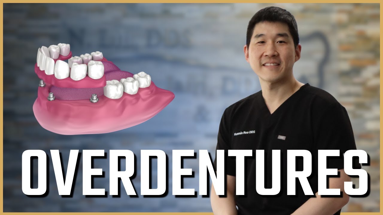 Implant Overdentures Explained with Dr. Roo