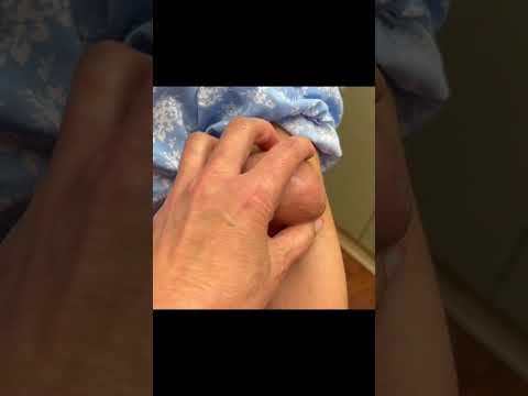 MASSIVE Arm Pilomatricoma