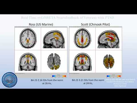 Real time swLoreta Neurofeedback of Veterans with PTSD