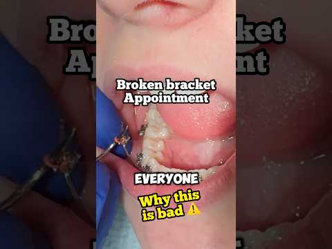 Broken Brackets? What to do? Read Description - Toothtime Family Dentistry New Braunfels Texas