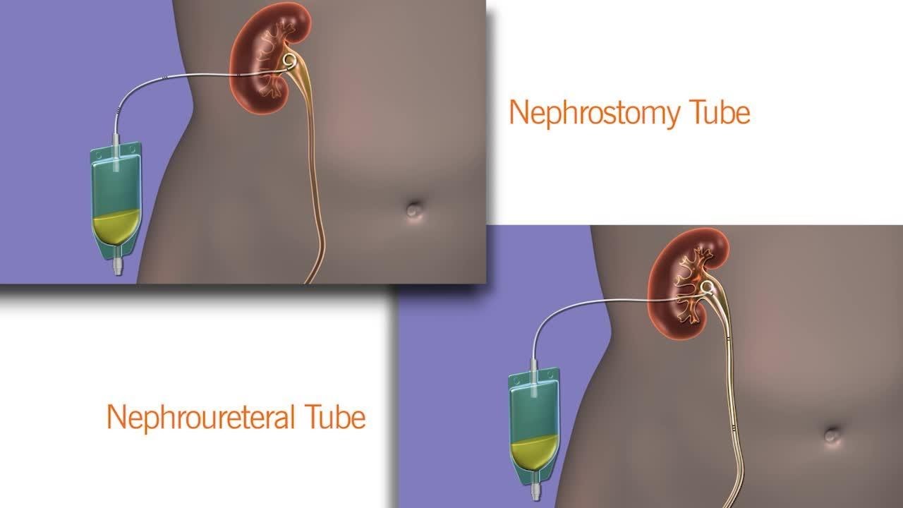 Your Nephrostomy or Nephroureteral Drain