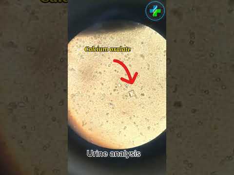 Urine analysis | urine microscopic examination | urinary tract infection | red blood cells | crystal