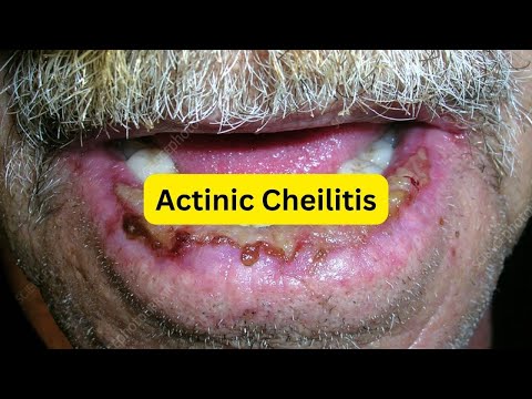 What is actinic cheilitis? EASY