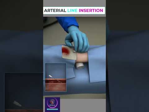 Arterial line insertion #shorts