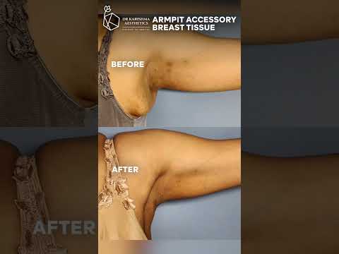 Before and After Results of Axillary Breast Tissue Removal | Dr Karishma Aesthetics