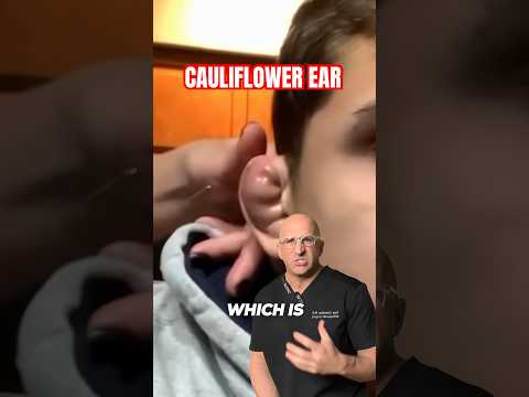 Dead Cartilage or Mark of Distinction⁉️ Cauliflower Ear #shorts