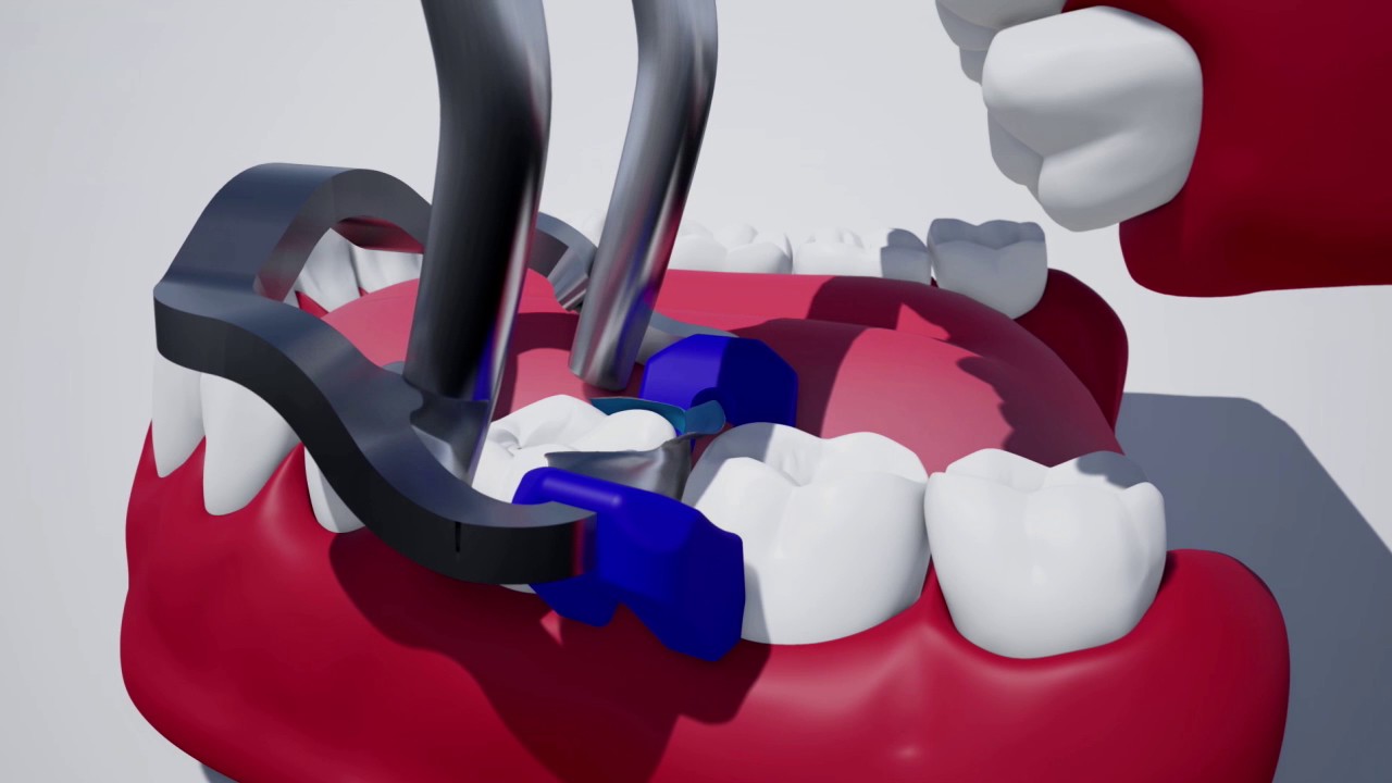 ContactPro® Sectional Matrix System by Microbrush® International