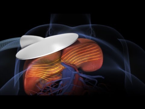 MRE Magnetic Resonance Elastography - Mayo Clinic