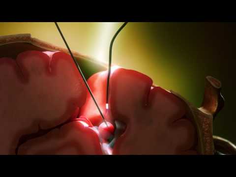 Retractorless Surgery to Access MCA Aneurysm