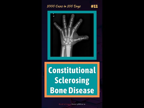Causes for Constitutional Bone Sclerosis | 1000 cases in 100 days | video-11 | Radiology Everywhere