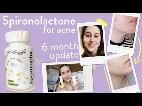 Spironolactone for acne month 6- looking much better!