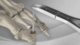 Patient Education in Orthopedic Surgery – OrthoPedia Patient