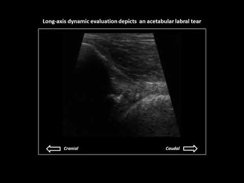 Acetabular labral tear on hip ultrasound (case 2)