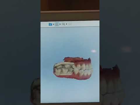 Orthodontic dentists in New York use intraoral scanners to map teeth. #orthodontics #dentist #braces