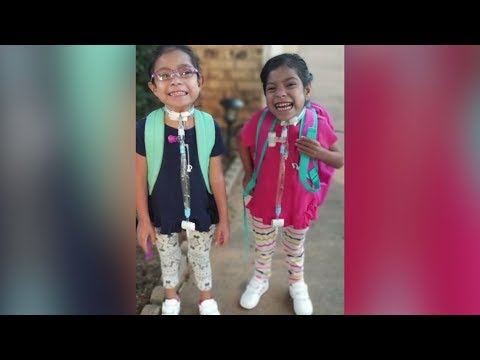Doctor Who Helped Separate Conjoined Twins Performs Follow-up Surgeries on One of the Girls