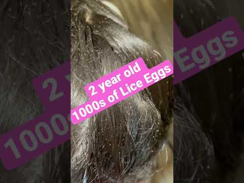 Toddler with 1000s of Lice Eggs l Extreme Lice Infestation l Lice Removal Service