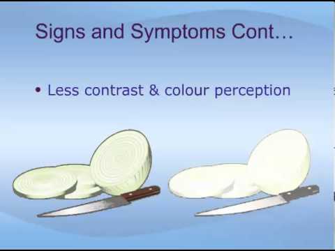 Wet Age-Related Macular Degeneration (Wet AMD)