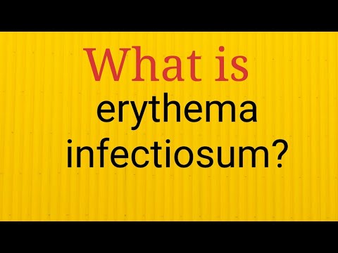 What is erythema infectiosum?