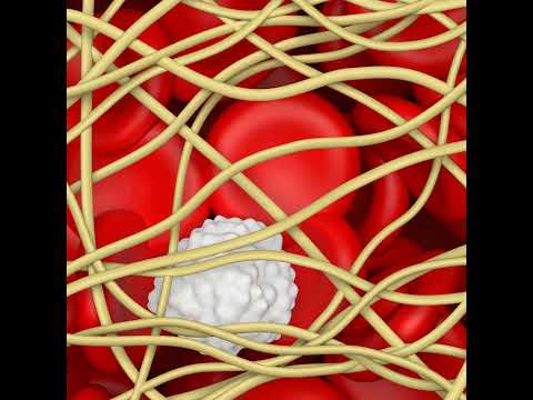 Pulmonary Embolism with Al Sacchettii, MD