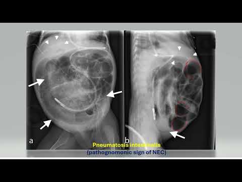 Necrotizing Enterocolitis (NEC)