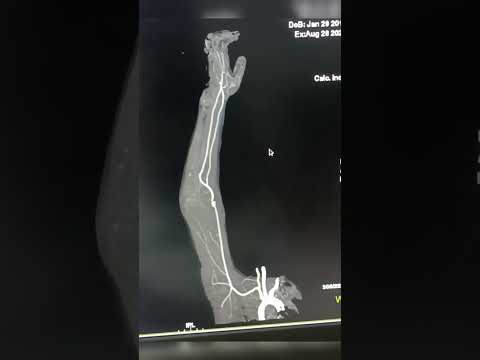 CT Upper limb Angiography | Artery of Hand | Blocked Artery #ctscan #ctangiography