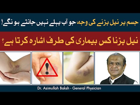 Unexplained Bruising On Body | Jism Par Neel Ke Nishan Kyun Party Hain?