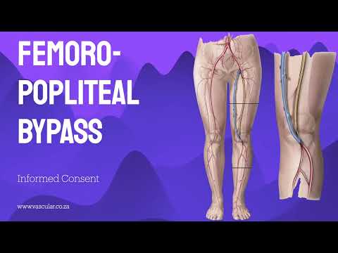 Femoro-popliteal Bypass - Informed Consent