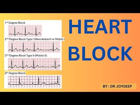 AV heart block... Definition Causes Mechanism Types clinical significance Treatment