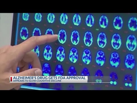 Ohio State University doctor played role in Alzheimer's drug trials